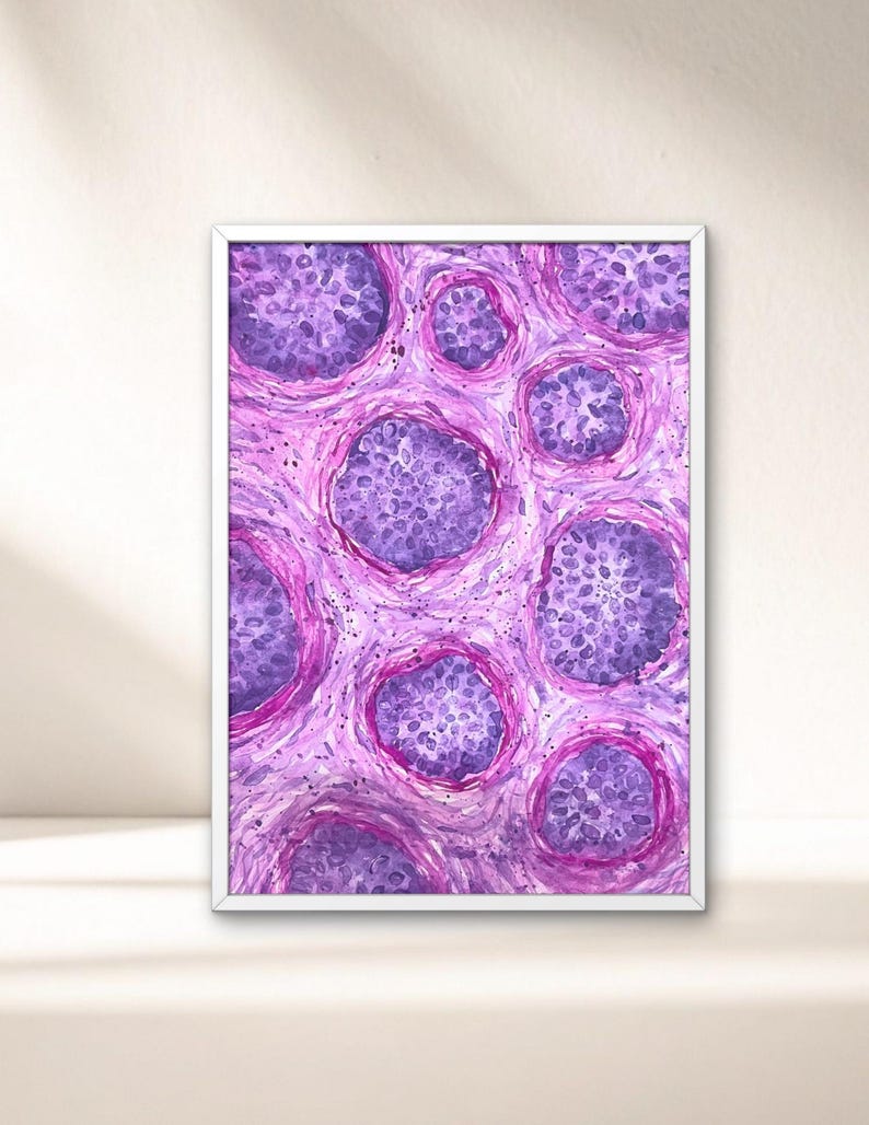 Brenner Tumor Ovary Histology Painting | Original Pathology Watercolor ...