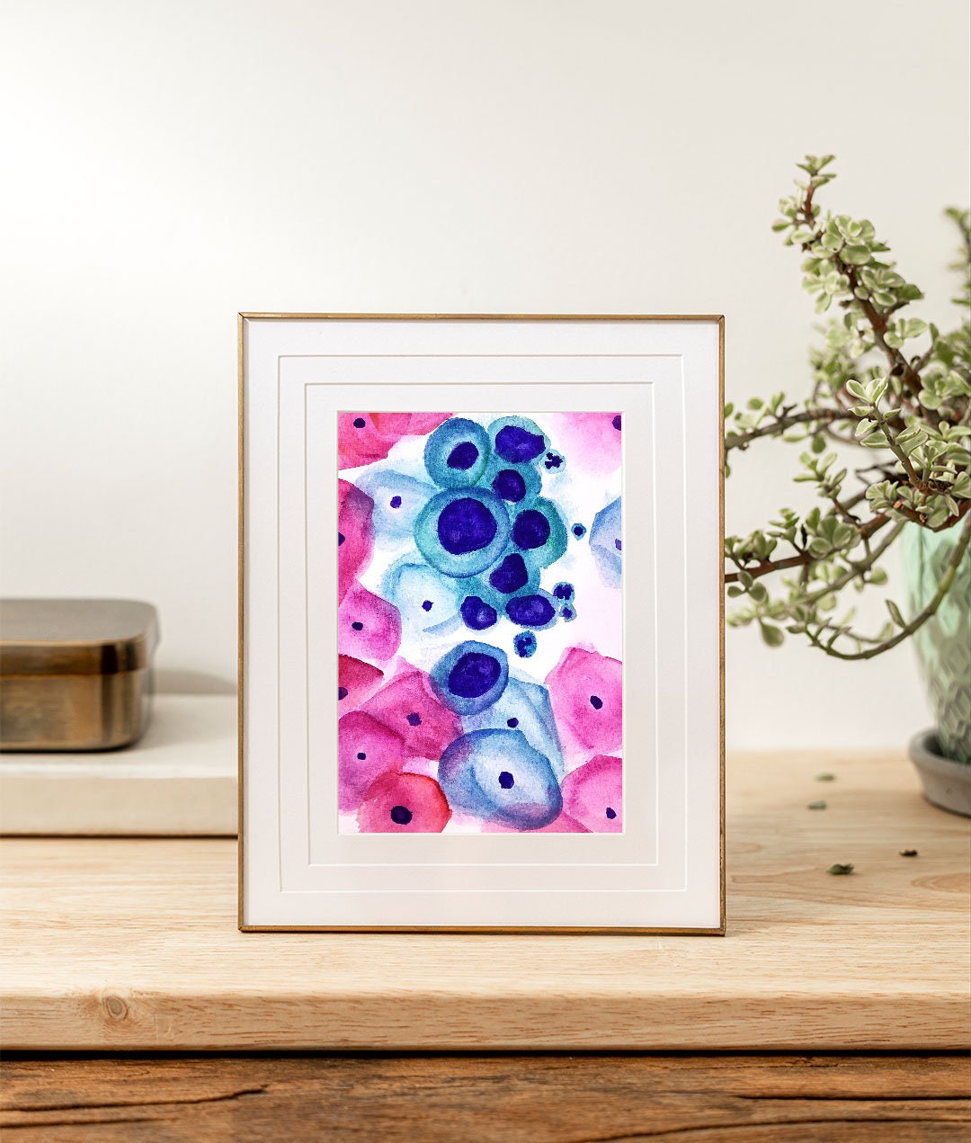 Pathology Art Print: PAP Smear, High-grade Squamous Intraepithelial ...