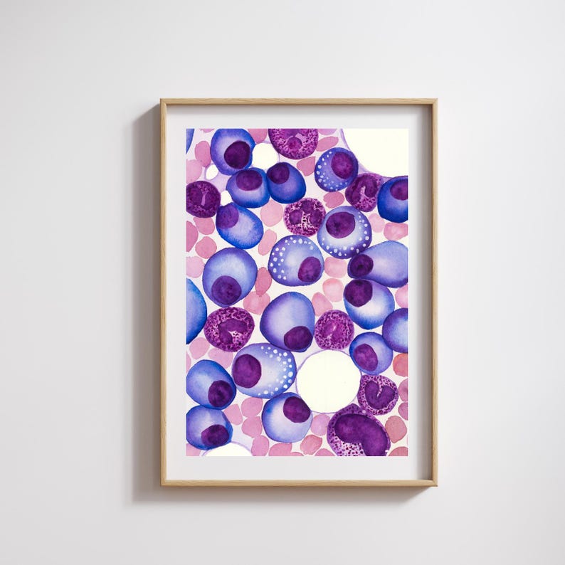 Hematopathology Art Print – Customer Favorite, Multiple Myeloma & Blood ...