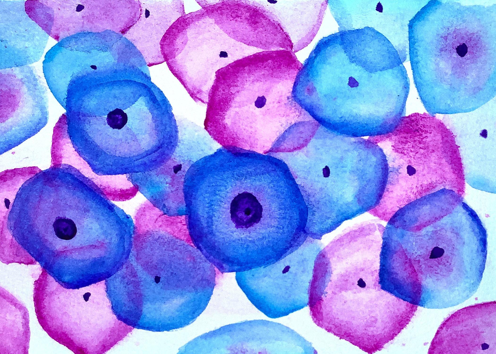 Pathology Art Print: Koilocytes, PAP Smear, LSIL - Etsy
