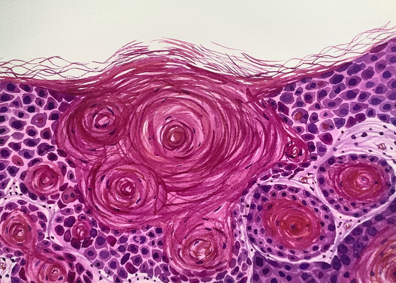 Squamous Cell Carcinoma, Skin Cancer, Pathology Print - Etsy
