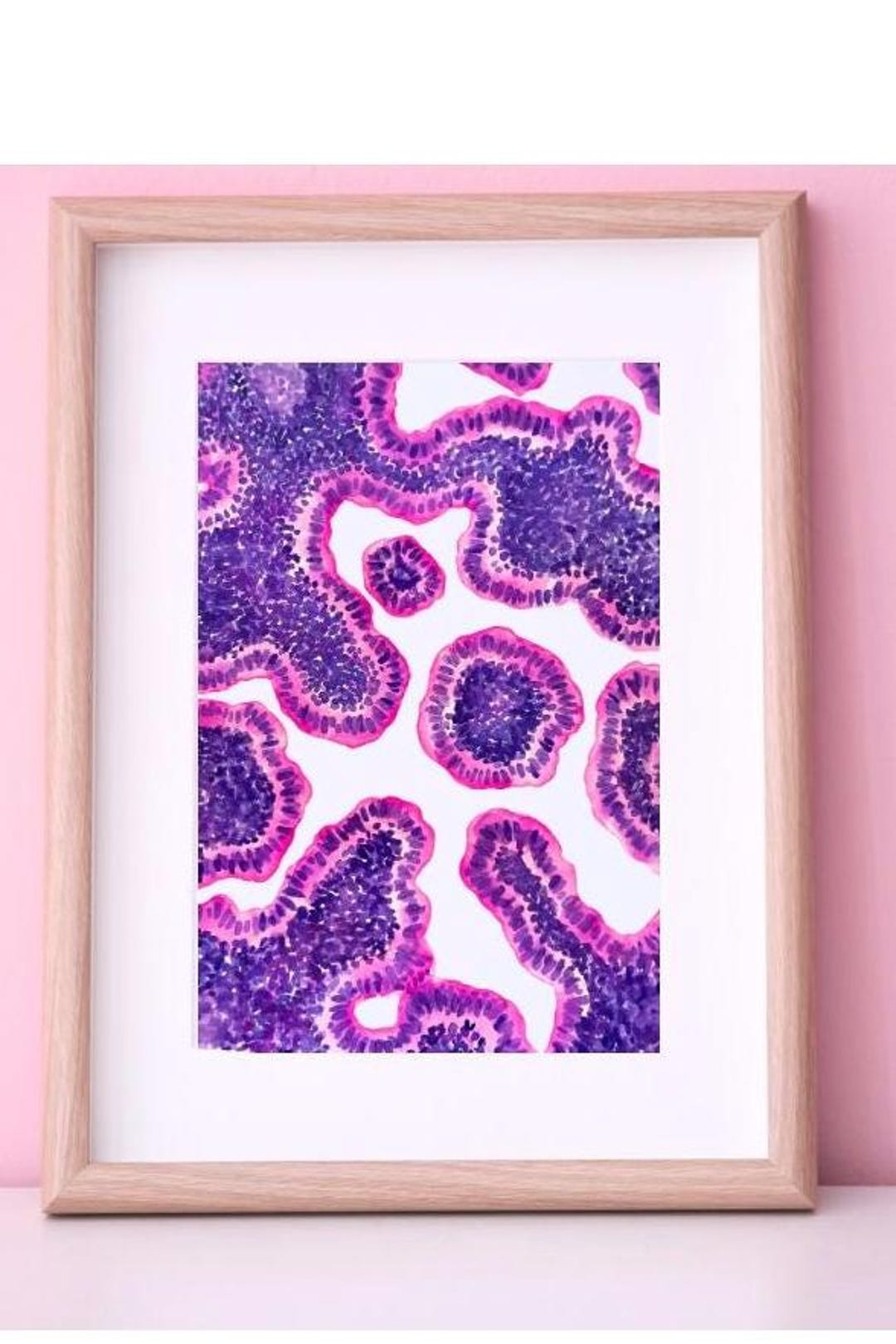 Warthin Tumor Salivary Gland Histology, Pathology Art Original Painting ...