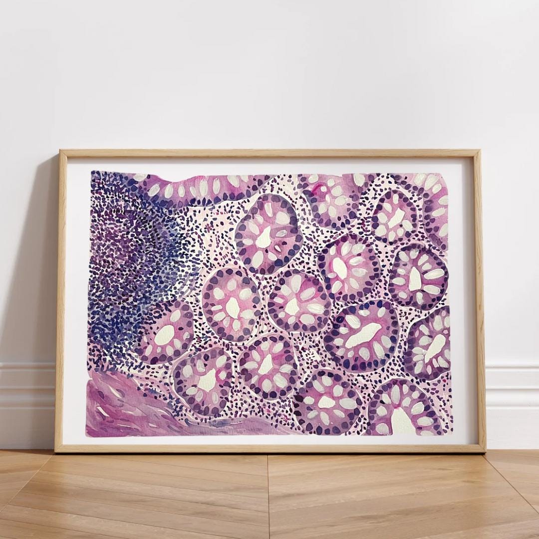 Colon With Peyers Patch, Pathology Art, 9x12" Watercolor - Etsy