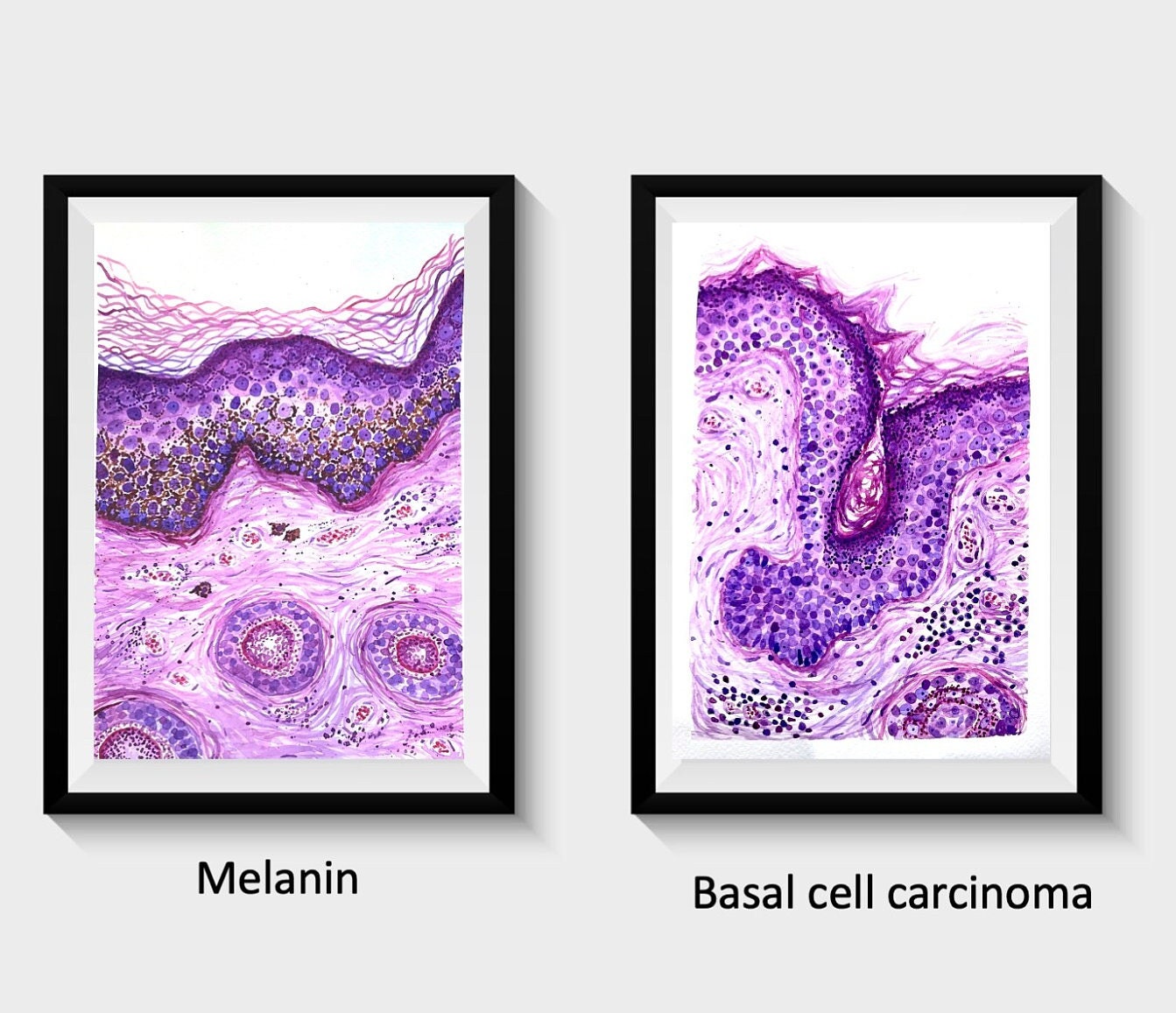 Skin Under the Microscope – Melanin, Dermatology, Pathology Art Print ...