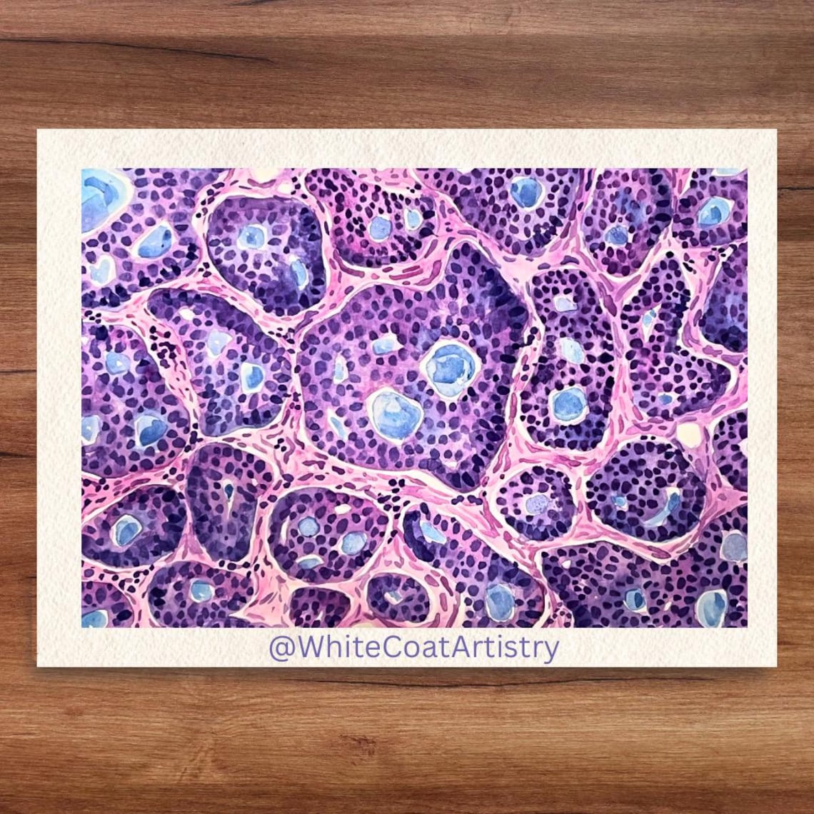 Adenoid Cystic Carcinoma Histology Painting | Original Pathology ...