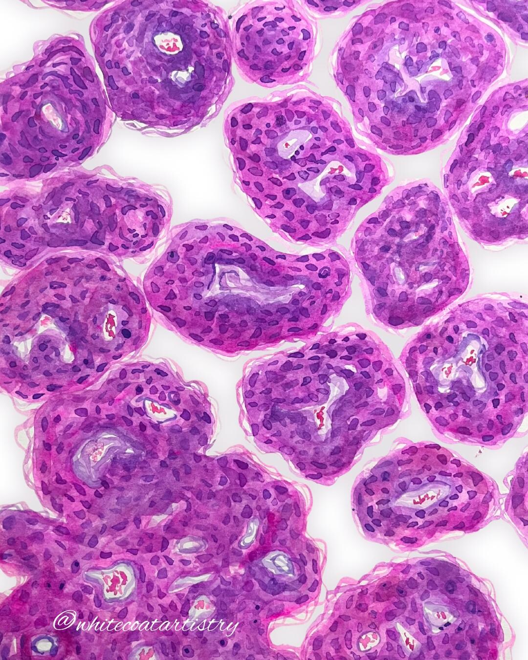 Squamous Papilloma Histology Painting | Original Pathology Watercolor ...