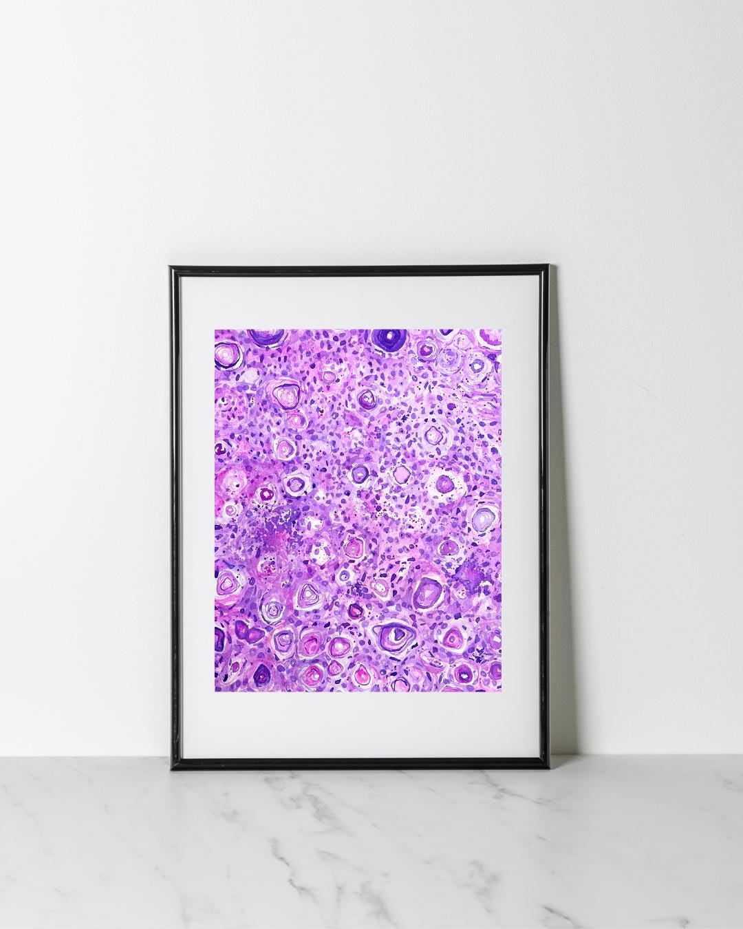 Brain Tumor Art – Original Meningioma Painting (9x12 Inches ...