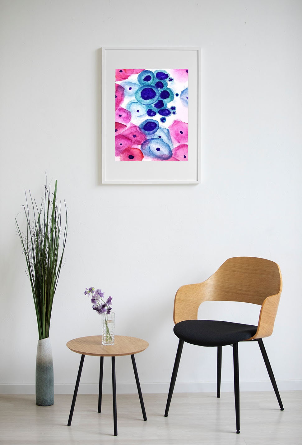 Pathology Art Print: PAP Smear, High-grade Squamous Intraepithelial ...