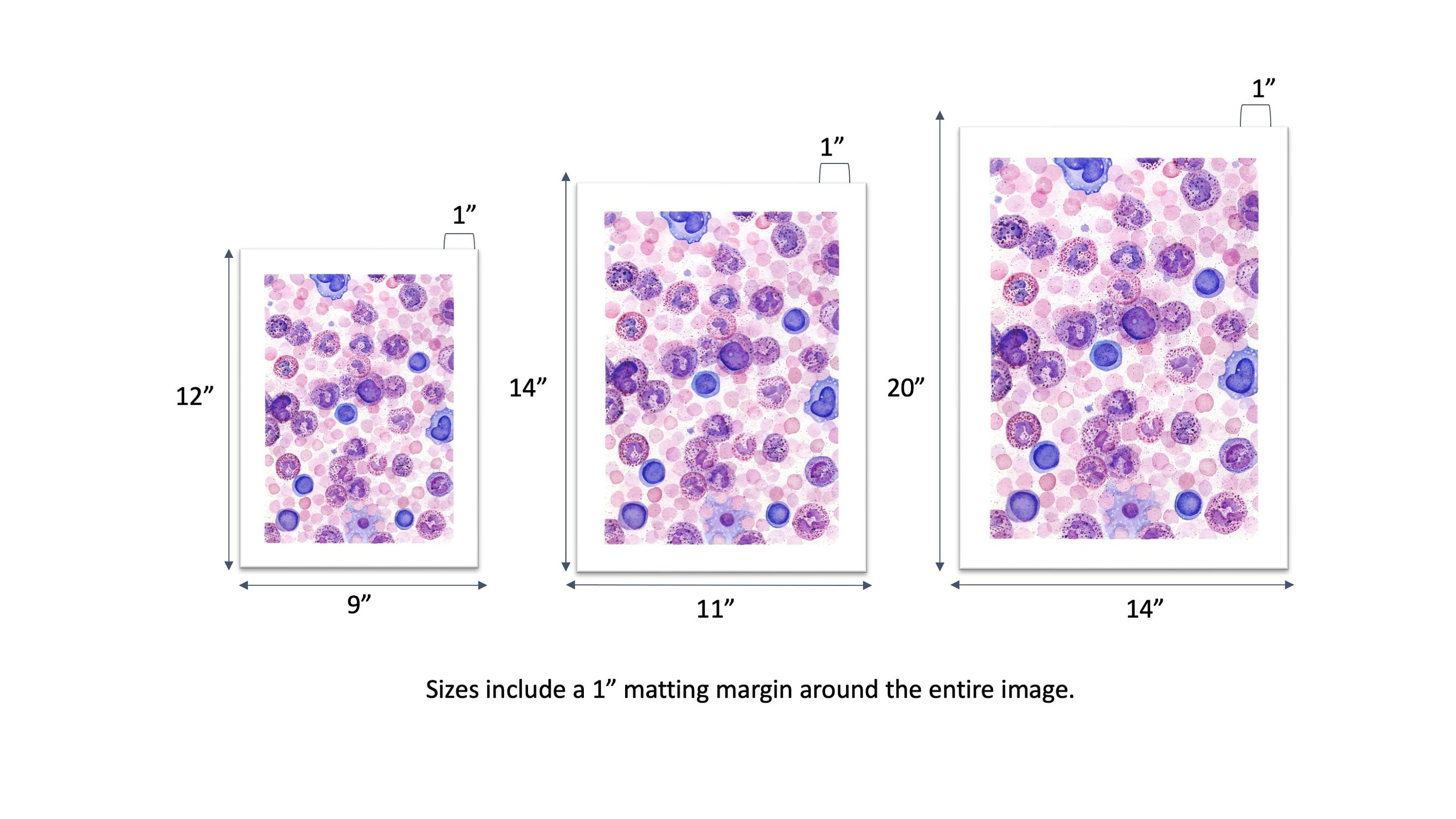 Chronic Myeloid Leukemia, Pathology Art Print - Etsy