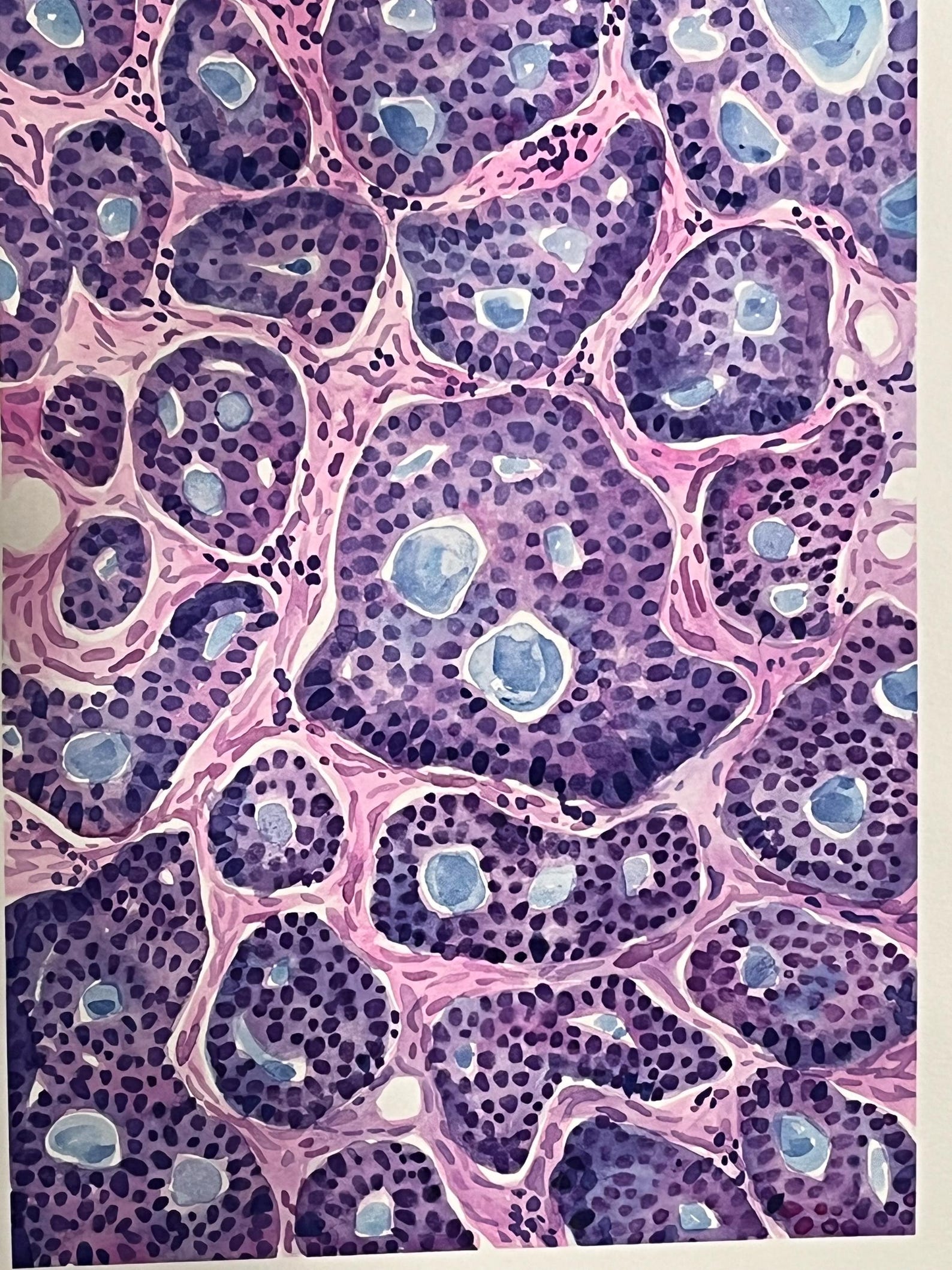 Adenoid Cystic Carcinoma Histology Painting | Original Pathology ...