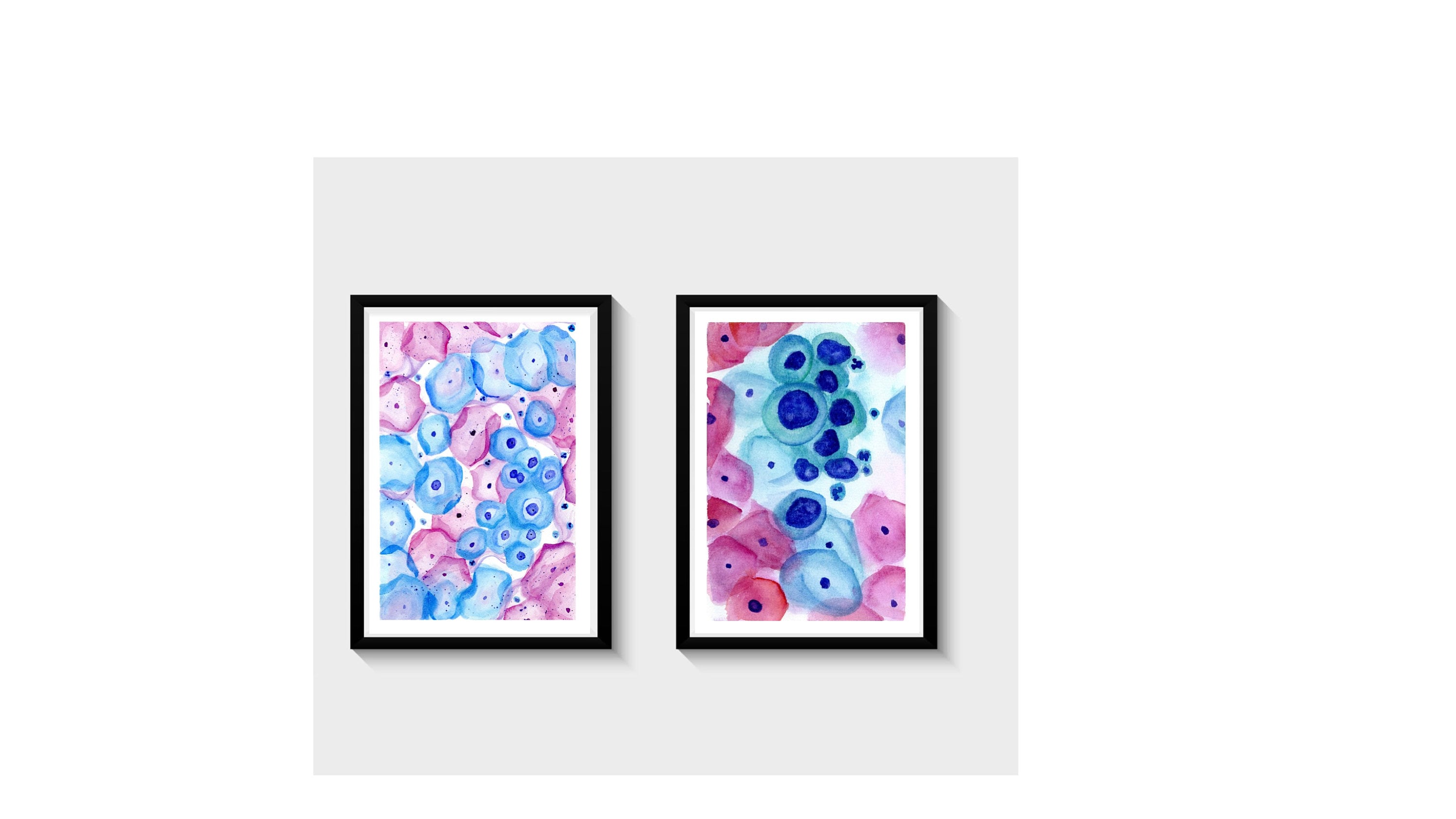 High-grade Intraepithelial Lesion (HSIL) on PAP Smear Painting Print ...