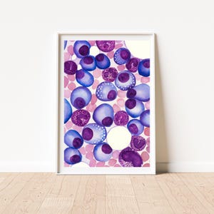 Hematopathology Art Print – Customer Favorite, Multiple Myeloma & Blood ...