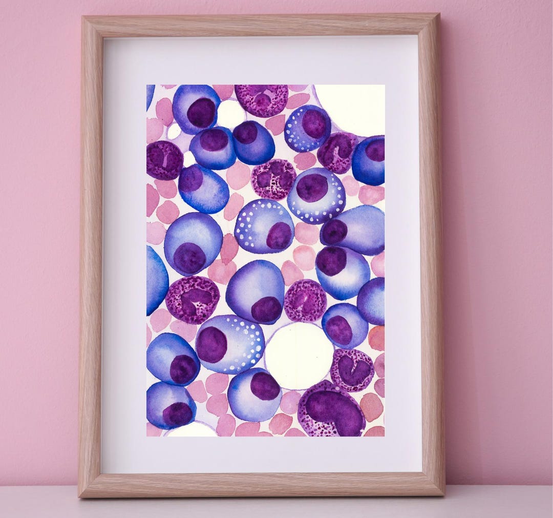 Multiple Myeloma Pathology Art Print, Hematopathology, Blood Cells - Etsy