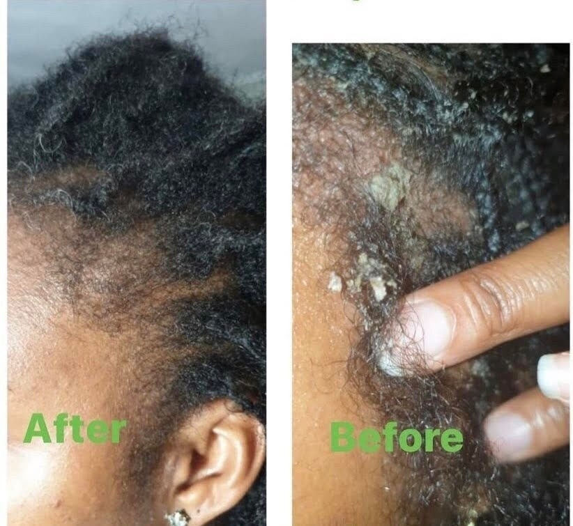Psoriasis Scalp African American