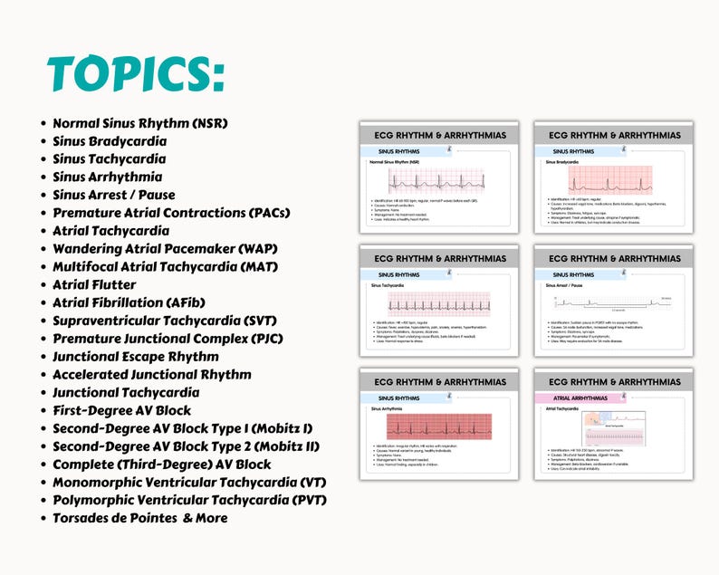ECG Rhythm & Dysrhythmias, Cheat Sheets, 100 Rhythms, Cardiac ICU ...