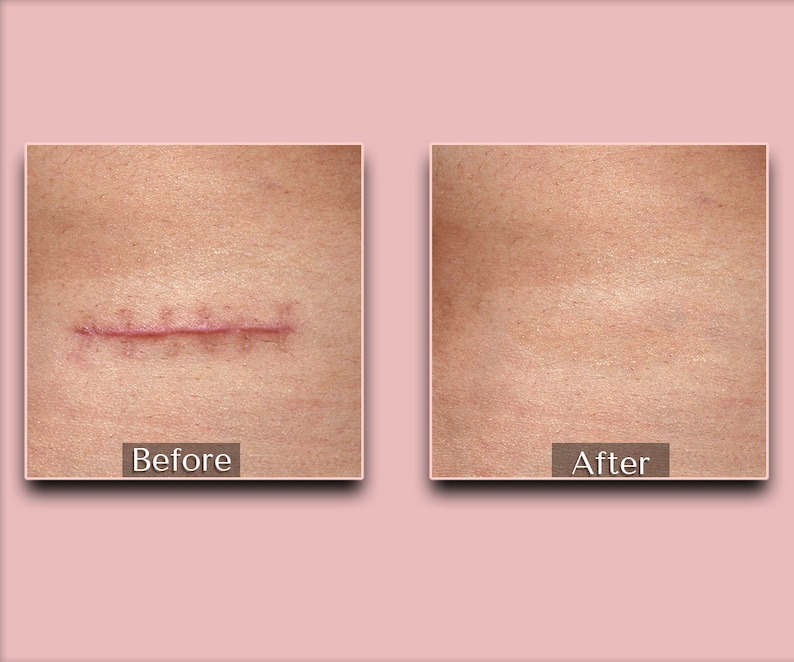 All Natural Oil Scar Remover, Reduce Surgery Scars, Stitches Scars ...