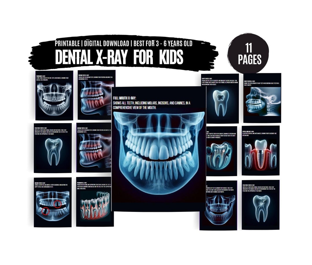 Printable Dental X-rays for Kids. Pretend Play Kids X-ray Activity for Dentist Role Play. Print ...