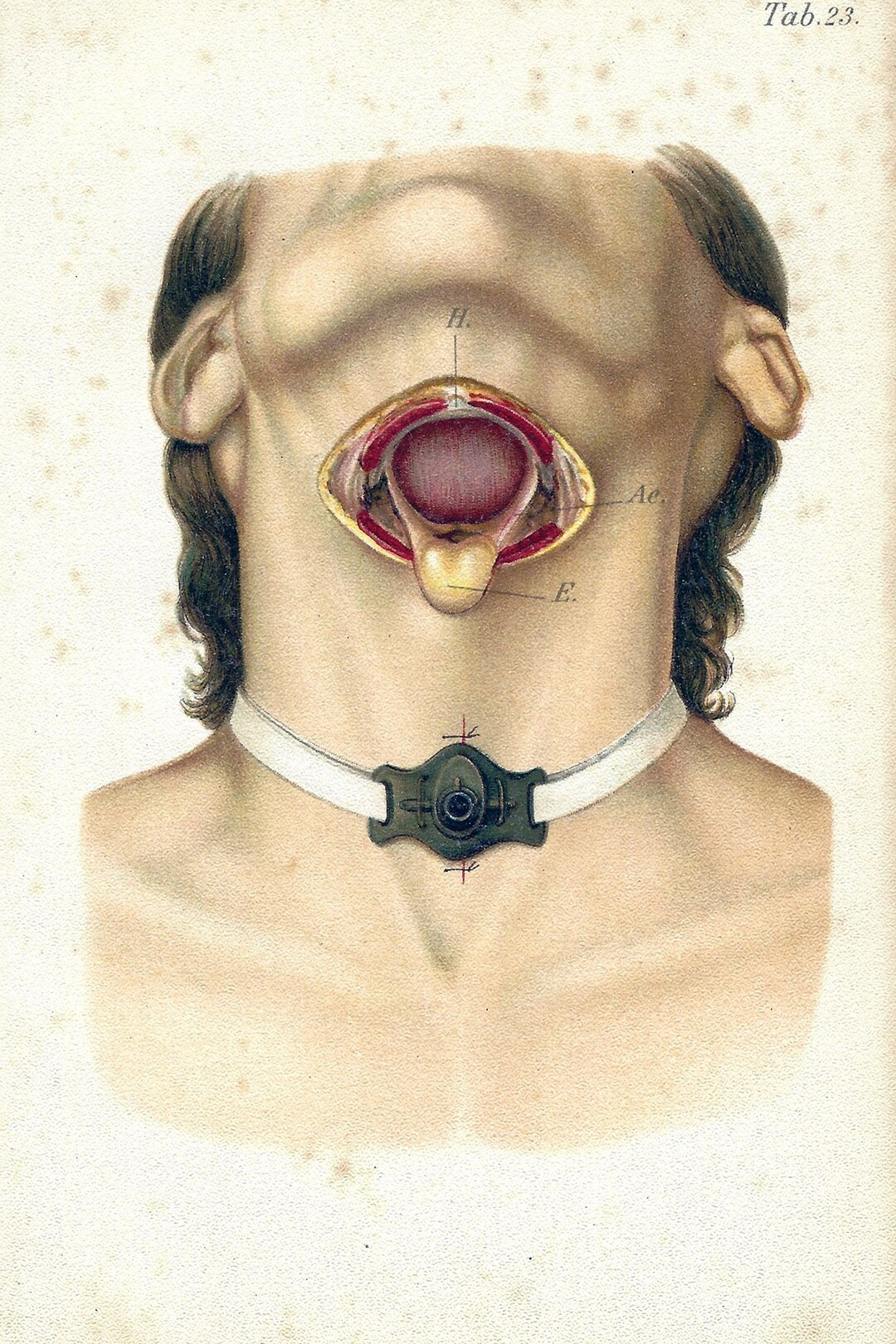 Tracheotomy Procedure and Anatomy | 1909 Colored Antique Medical ...