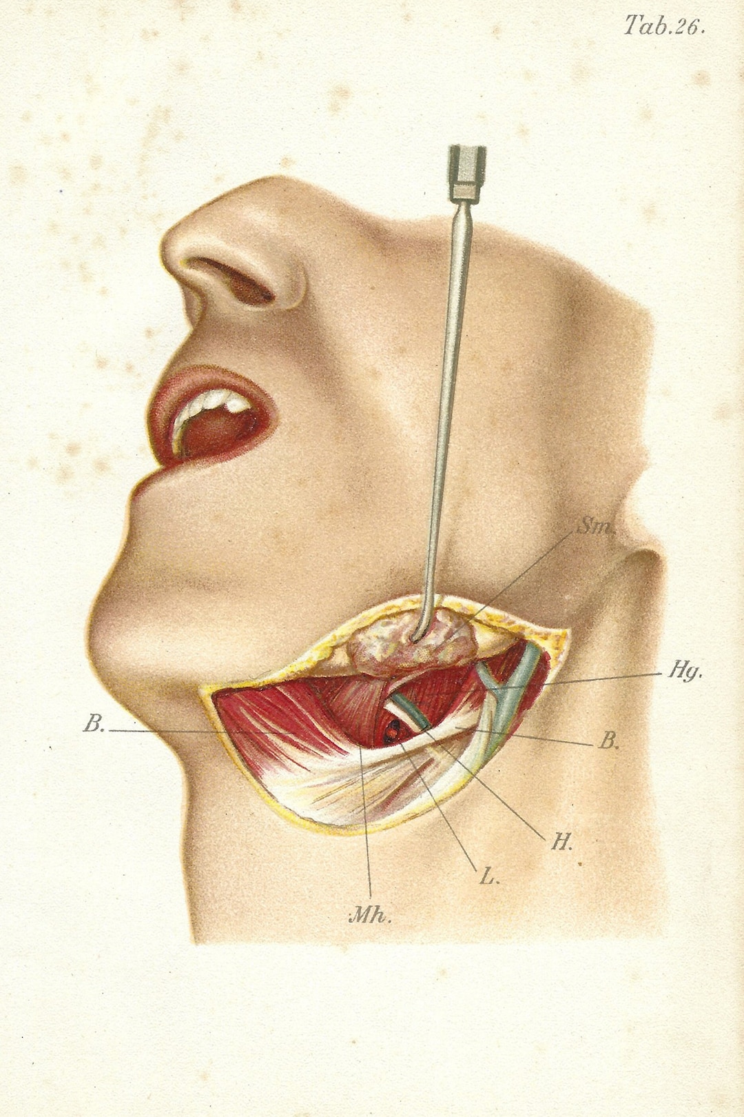 Lingual Artery Exposure | 1909 Colored Antique Medical Lithograph ...