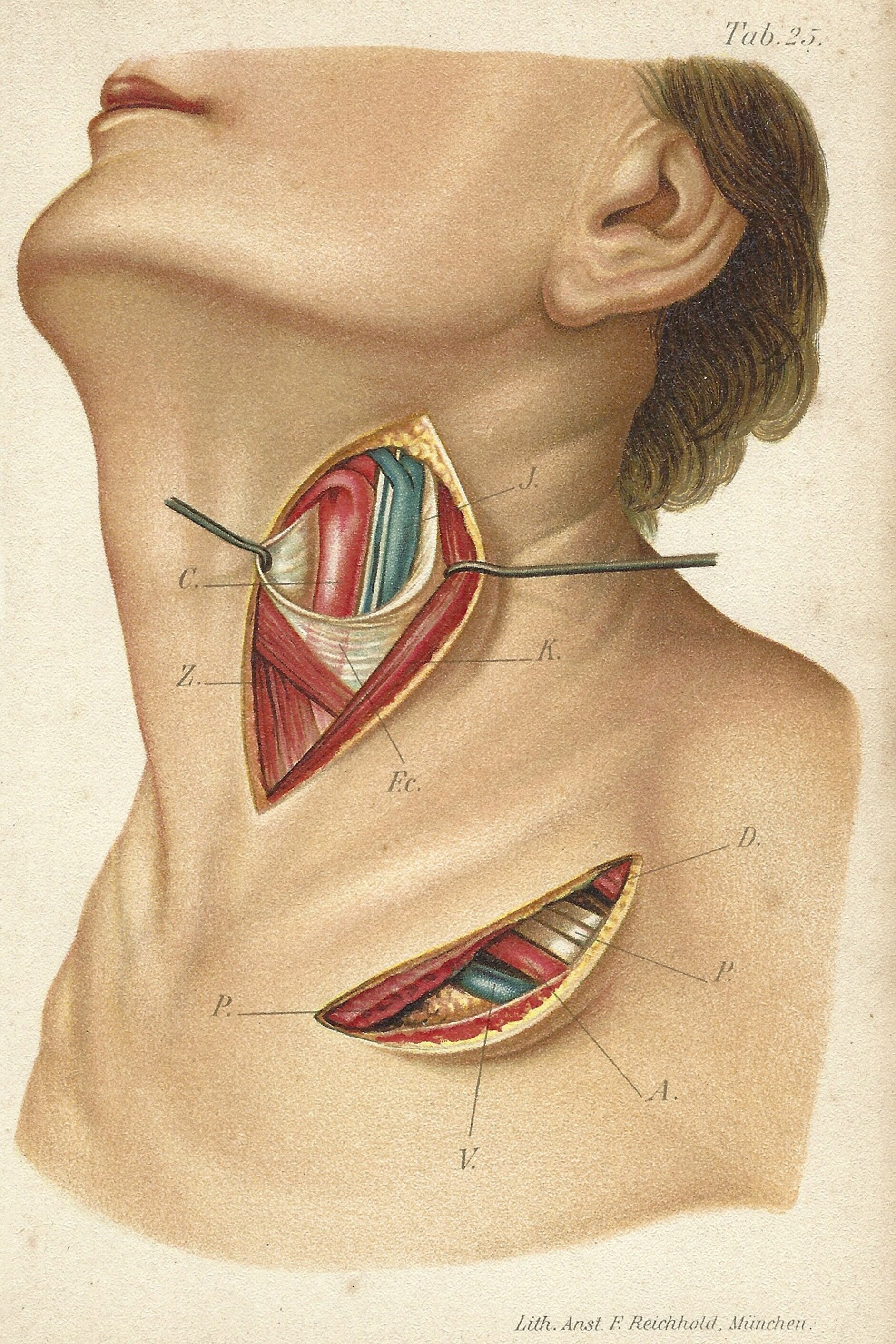 Carotid/subclavian Exposure | 1909 Colored Antique Medical Print ...