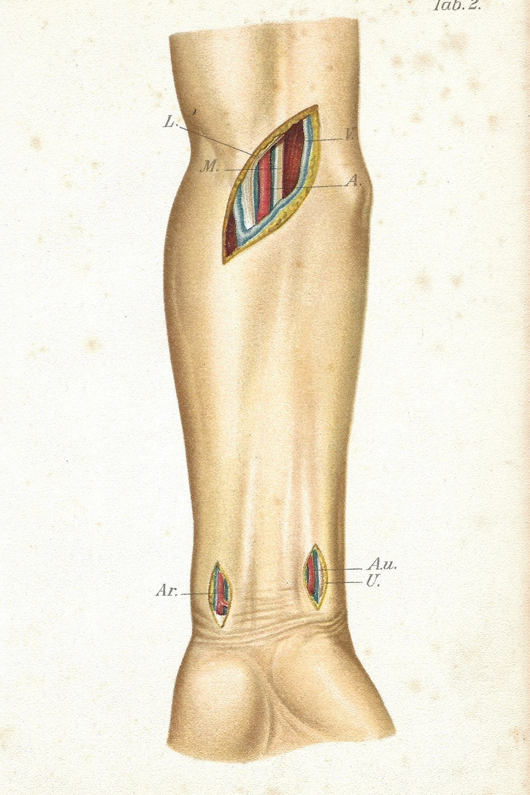 Forearm Arteries Exposure | 1909 Colored Antique Medical Lithograph ...