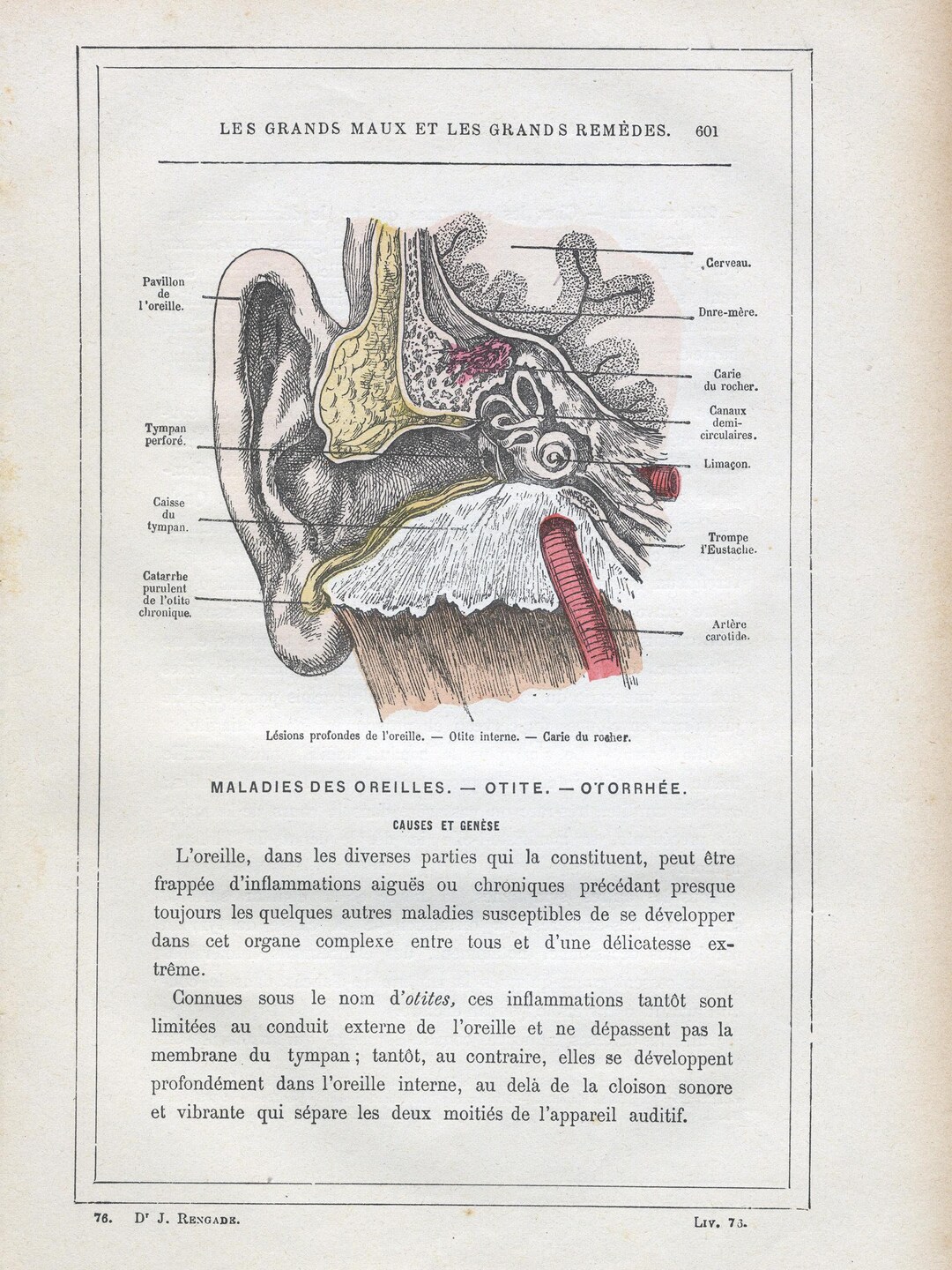 Antique French Ear Anatomy Print (1889) by Dr. J. Rengade | Otitis ...