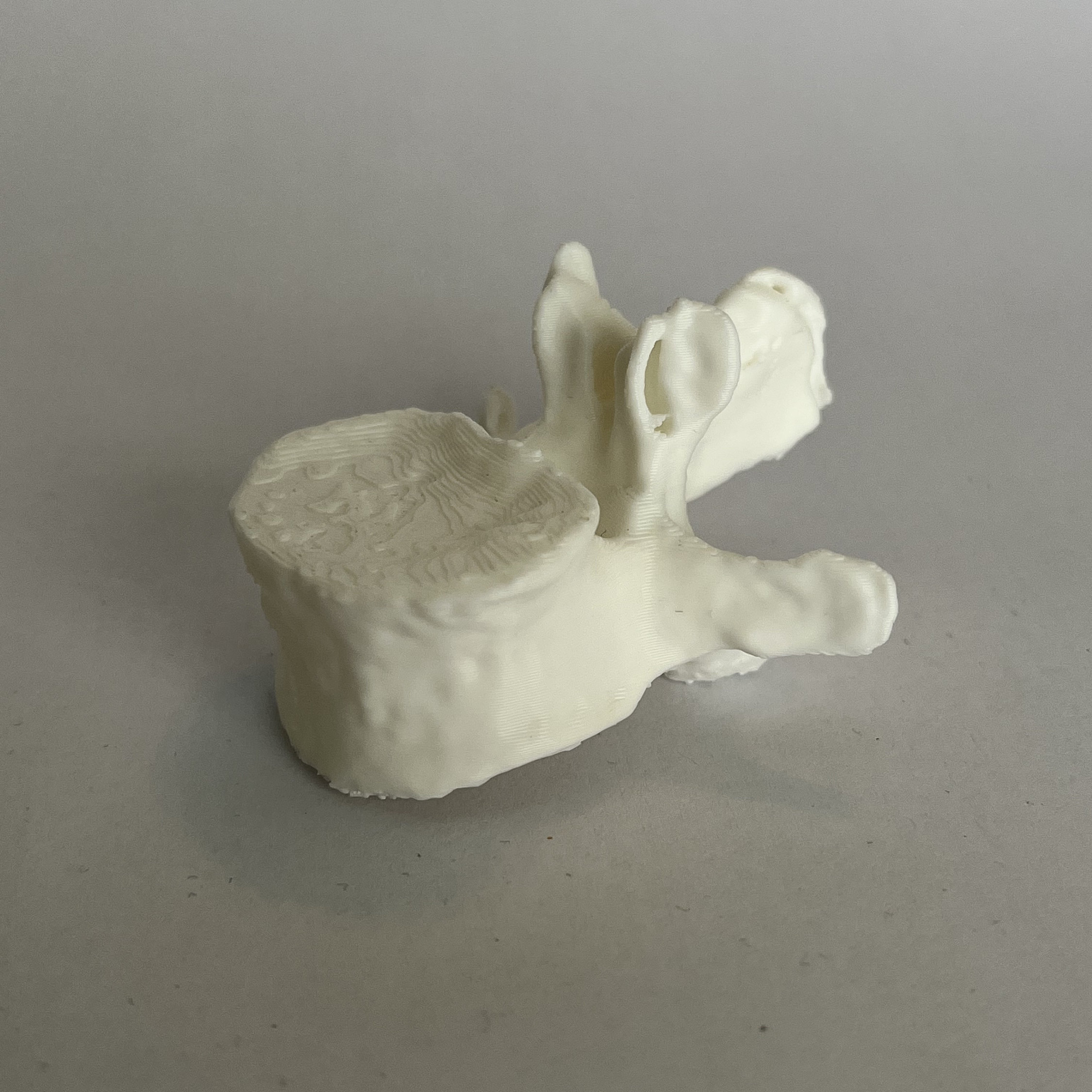 3d Printed Vertebrae