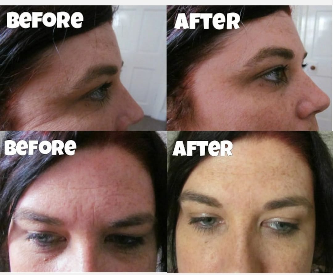 BOTOX ALTERNATIVE Miracle One 1 Minute Instant Facelift Wrinkle Remover ...