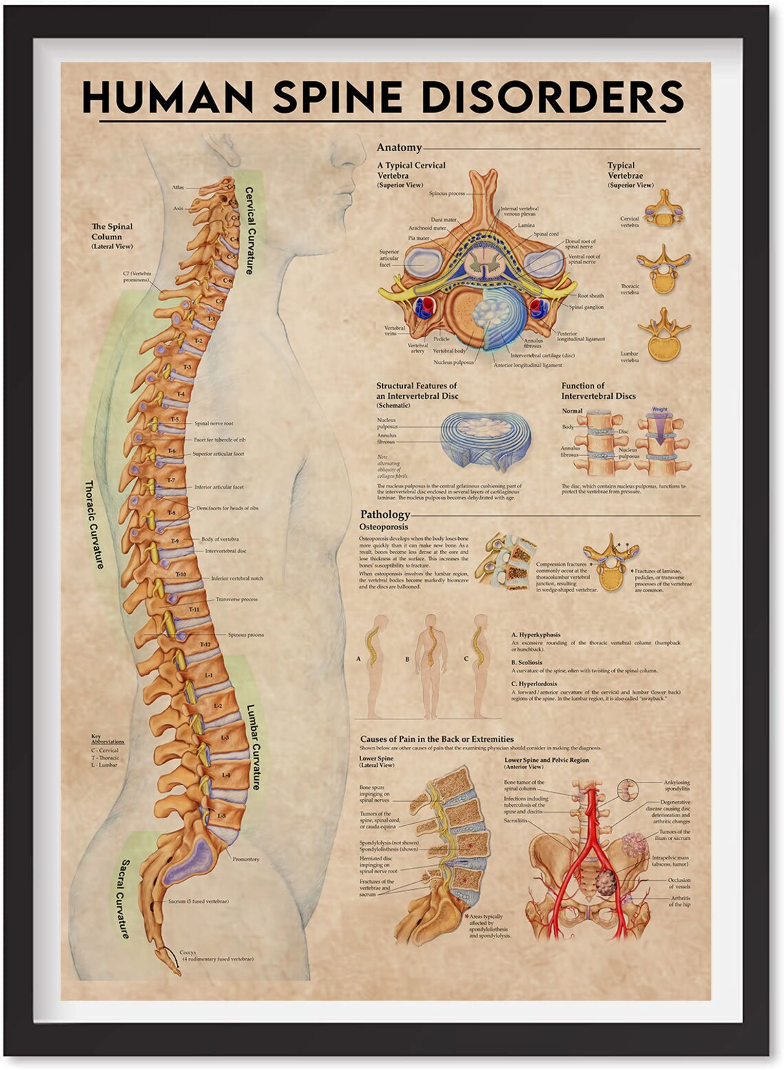 Human Spine Disorders Poster, Sticker Spine Knowledge Doctor Office ...