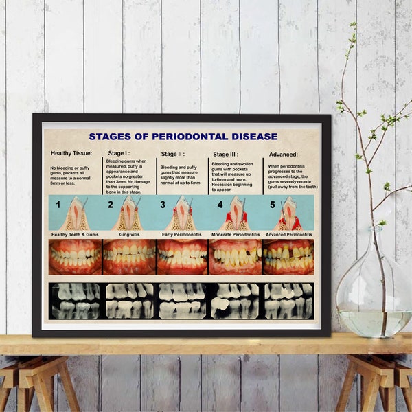 Periodontal Disease Stages Poster - Etsy