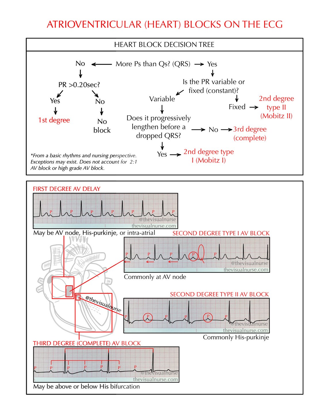 Basic Heart Blocks on ECG PDF Instant Download - Etsy UK