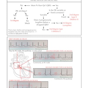 Basic Heart Blocks on ECG PDF Instant Download - Etsy