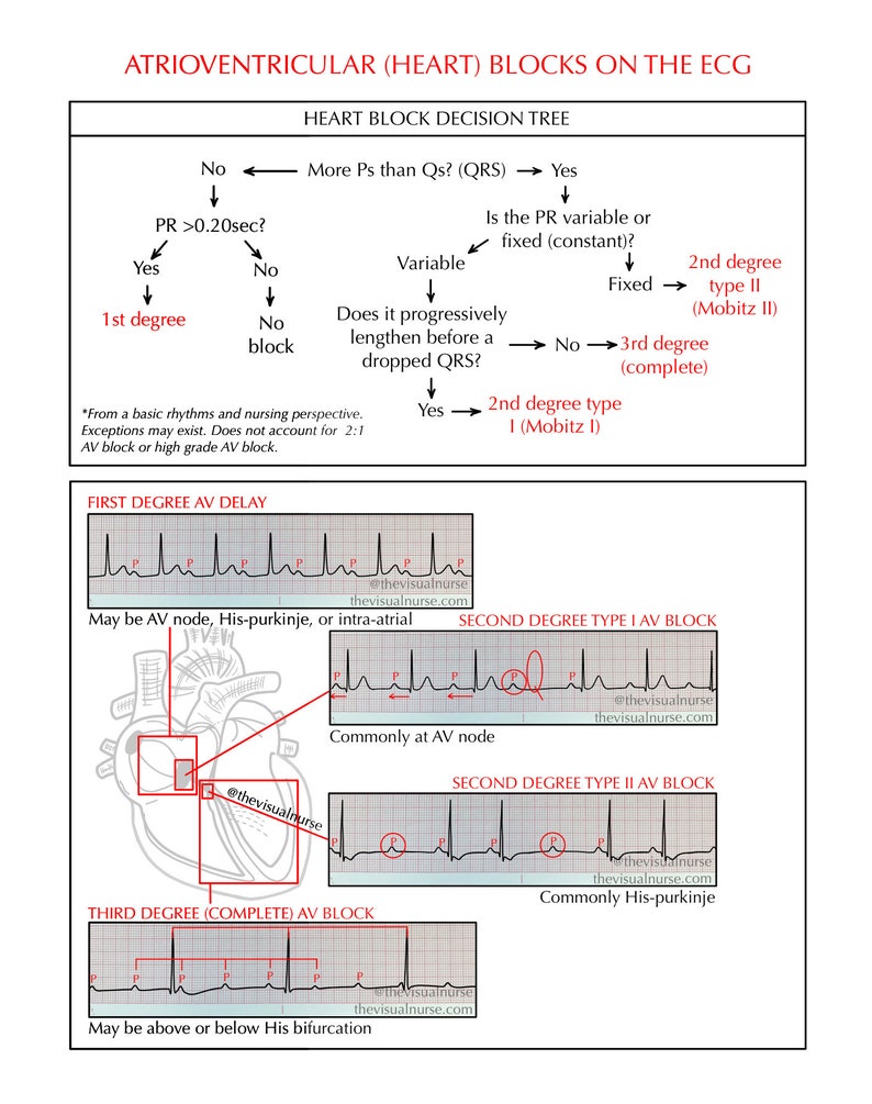 Basic Heart Blocks on ECG PDF Instant Download - Etsy
