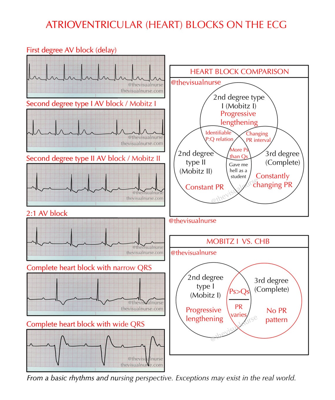 Basic Heart Blocks on ECG PDF Instant Download - Etsy