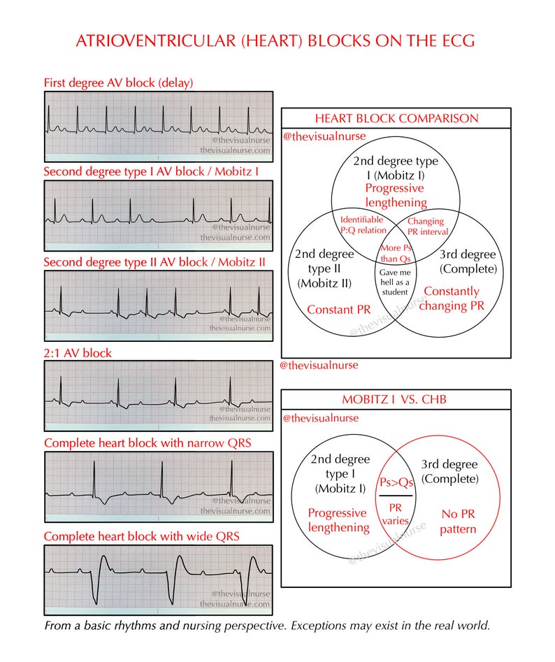 Basic Heart Blocks on ECG PDF Instant Download - Etsy UK