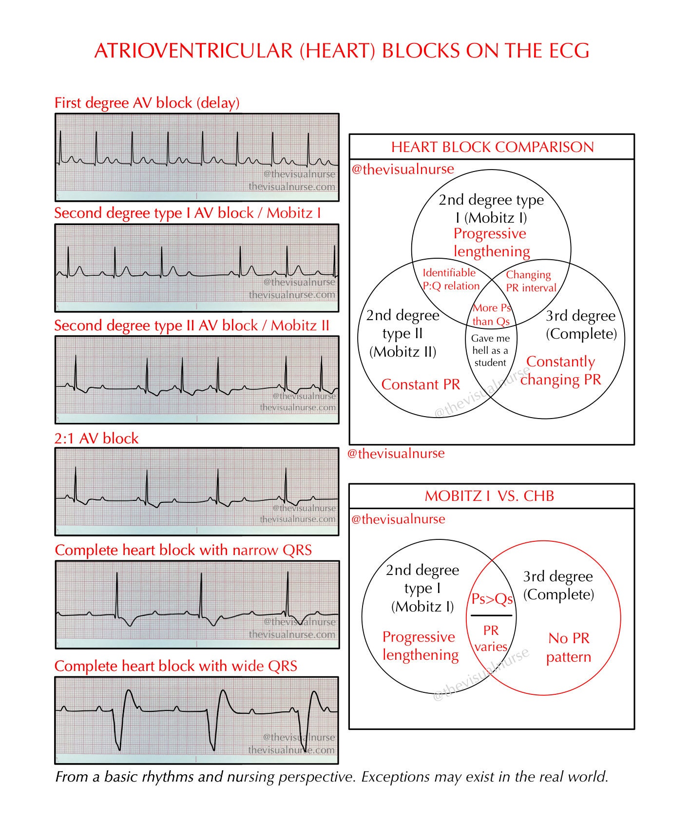 Basic Heart Blocks on ECG PDF Instant Download - Etsy