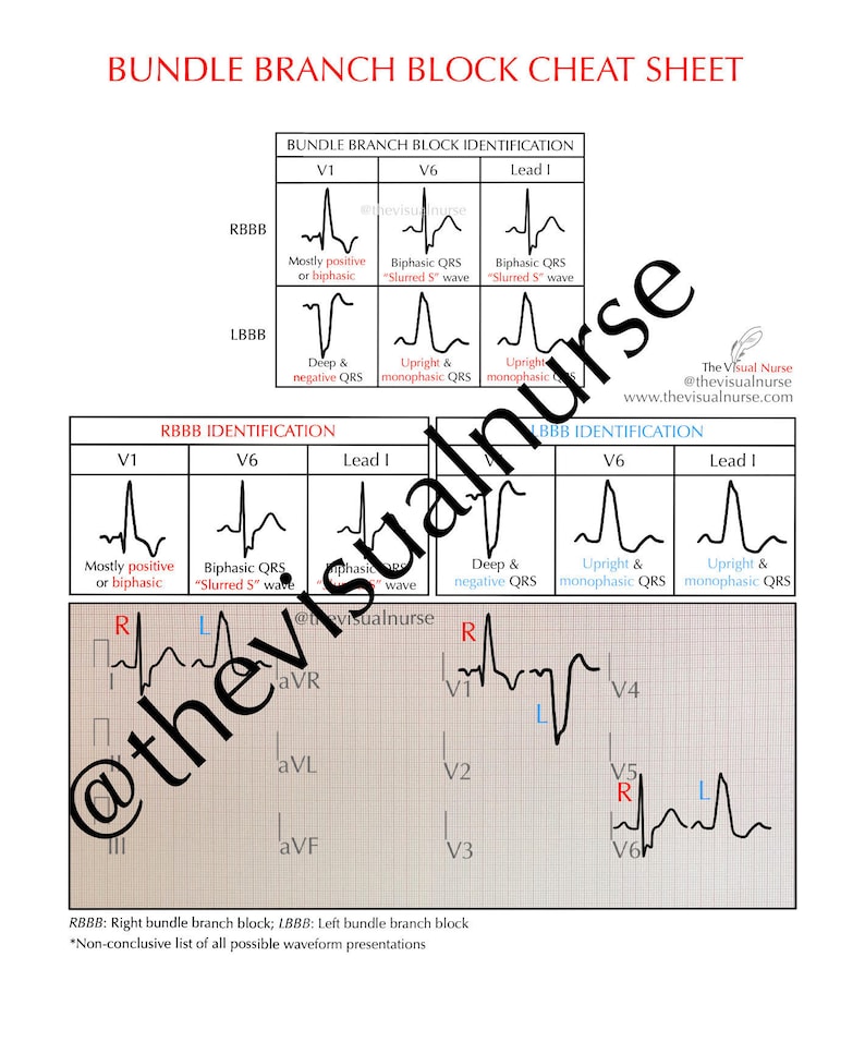 Bundle Branch Blocks on ECG PDF Instant Download - Etsy