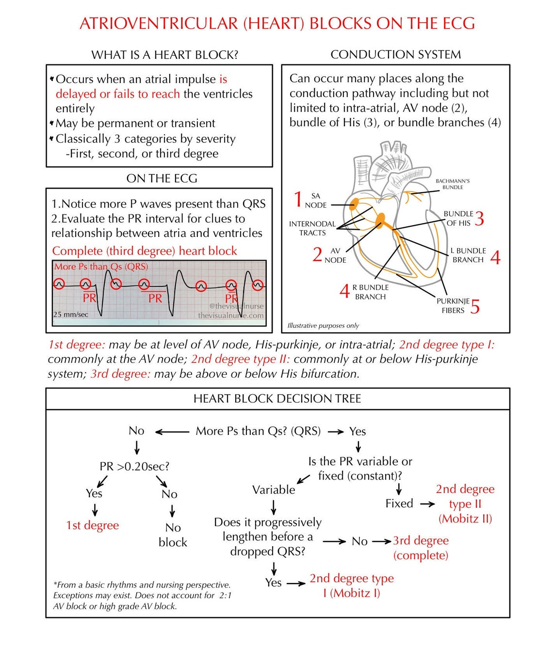 Basic Heart Blocks on ECG PDF Instant Download - Etsy UK