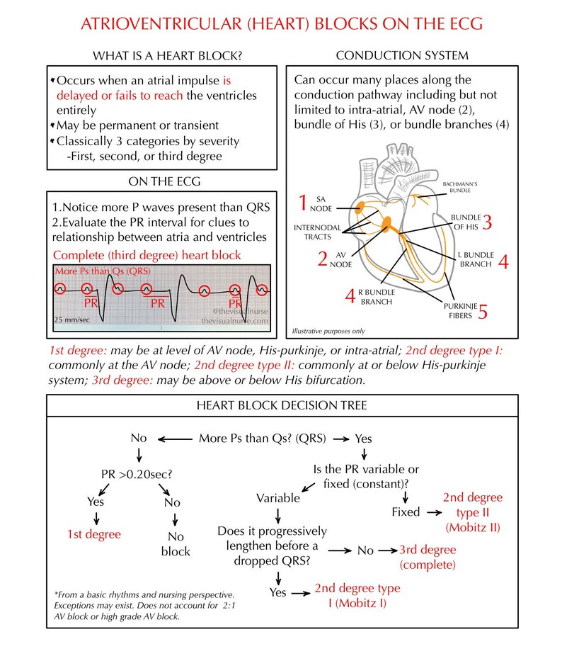 Basic Heart Blocks on ECG PDF Instant Download - Etsy
