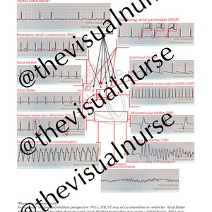 Common Cardiac Rhythms and Arrhythmias - PDF Instant Download - Etsy
