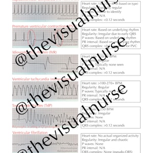 Common Cardiac Rhythms and Arrhythmias - PDF Instant Download - Etsy