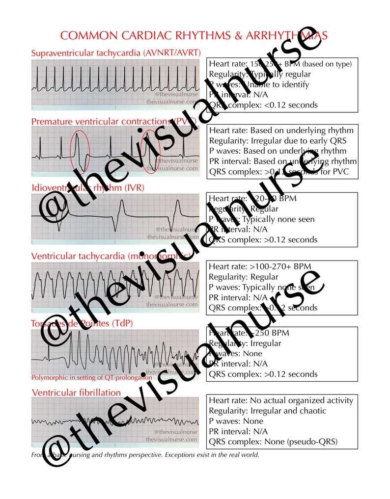 Common Cardiac Rhythms and Arrhythmias - PDF Instant Download - Etsy