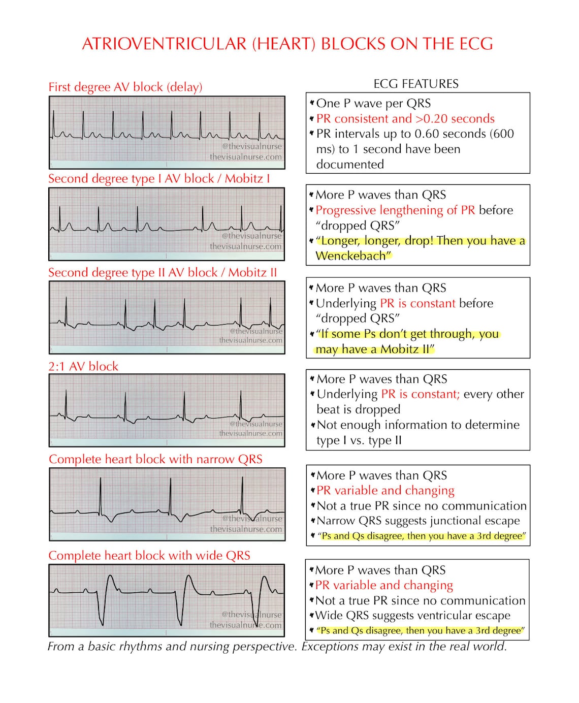 Basic Heart Blocks on ECG PDF Instant Download - Etsy UK