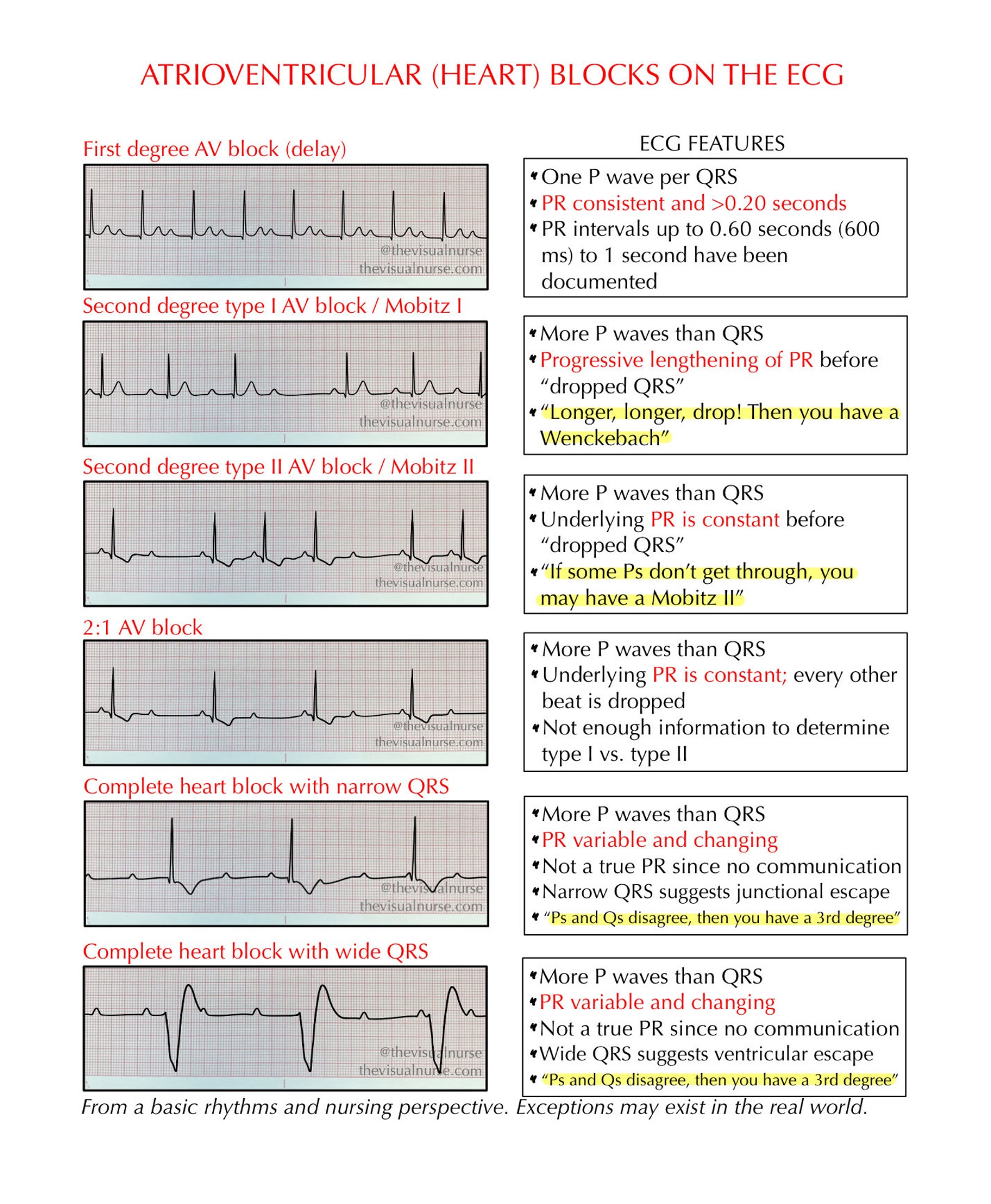 Basic Heart Blocks on ECG PDF Instant Download - Etsy UK
