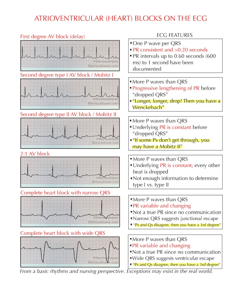 Basic Heart Blocks on ECG PDF Instant Download - Etsy