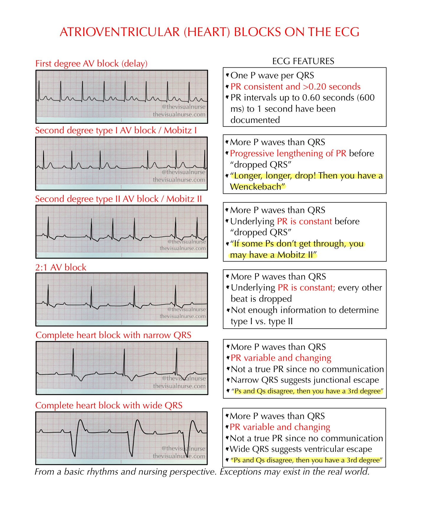 Basic Heart Blocks on ECG PDF Instant Download - Etsy