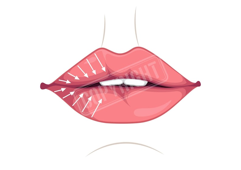 Fundamental Lip Filler Injection Techniques Bundle | Lip Anatomy ...