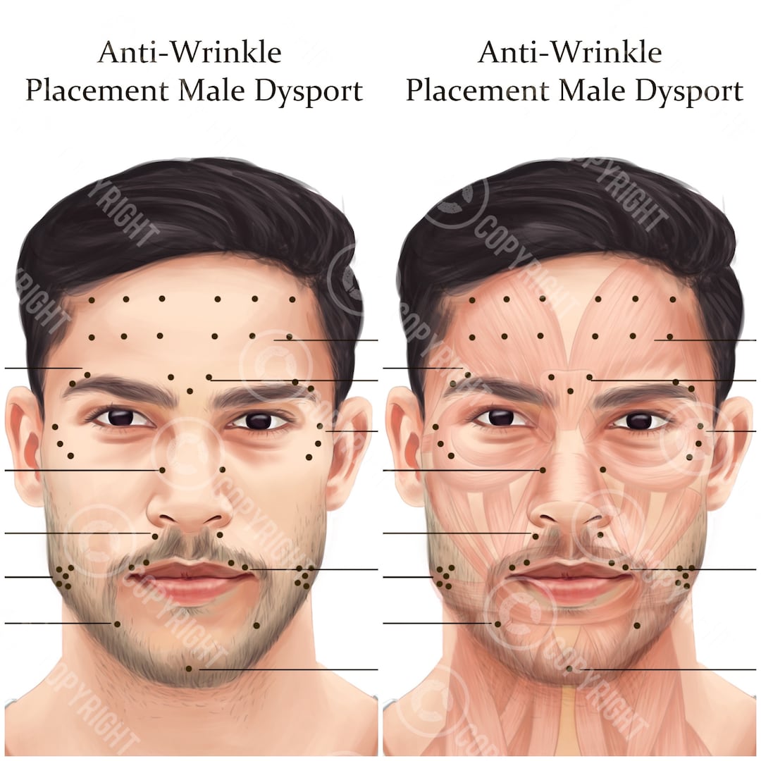 Male Dysport Injection Points Bundle | Botox & Filler Injector ...