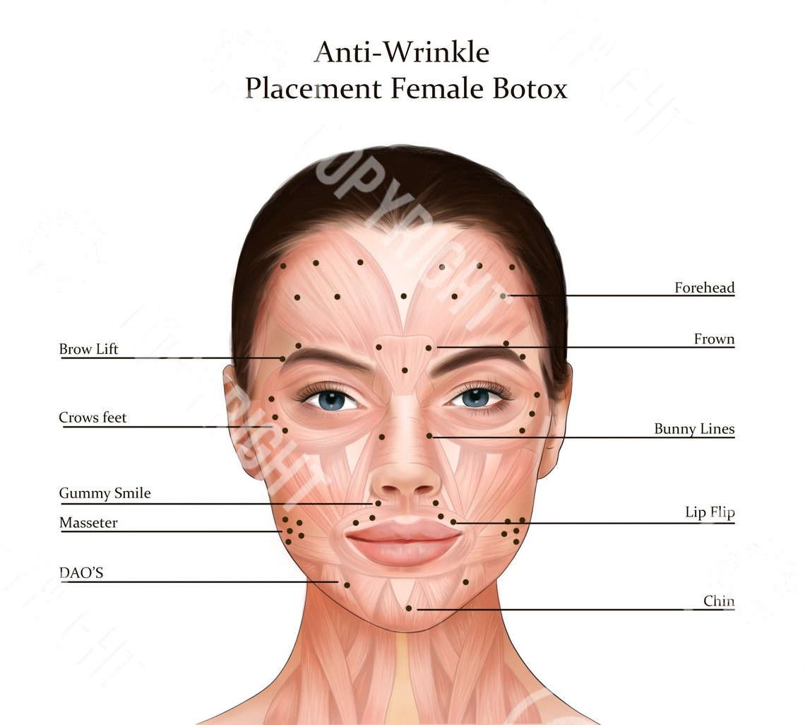Botox Injection Points Bundle | Botox & Filler Injector | Anatomy | Art ...