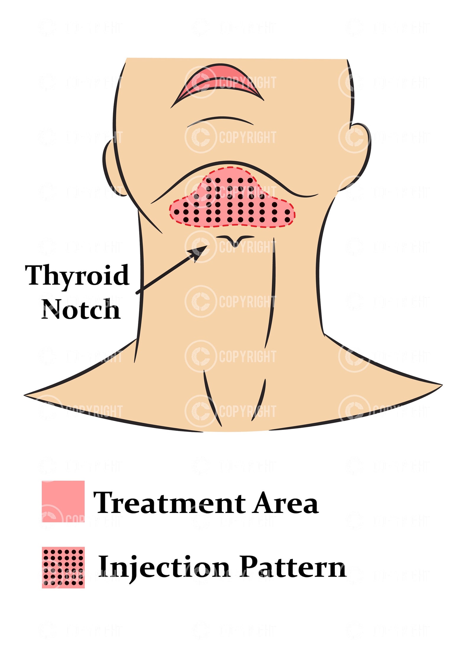 Fat Dissolving Injection Pattern | Aqualyx | Deso | Lipolab | Botox ...